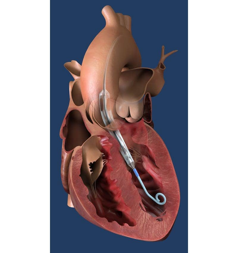 FDA Approves Abiomed’s Impella ECP Heart Pump