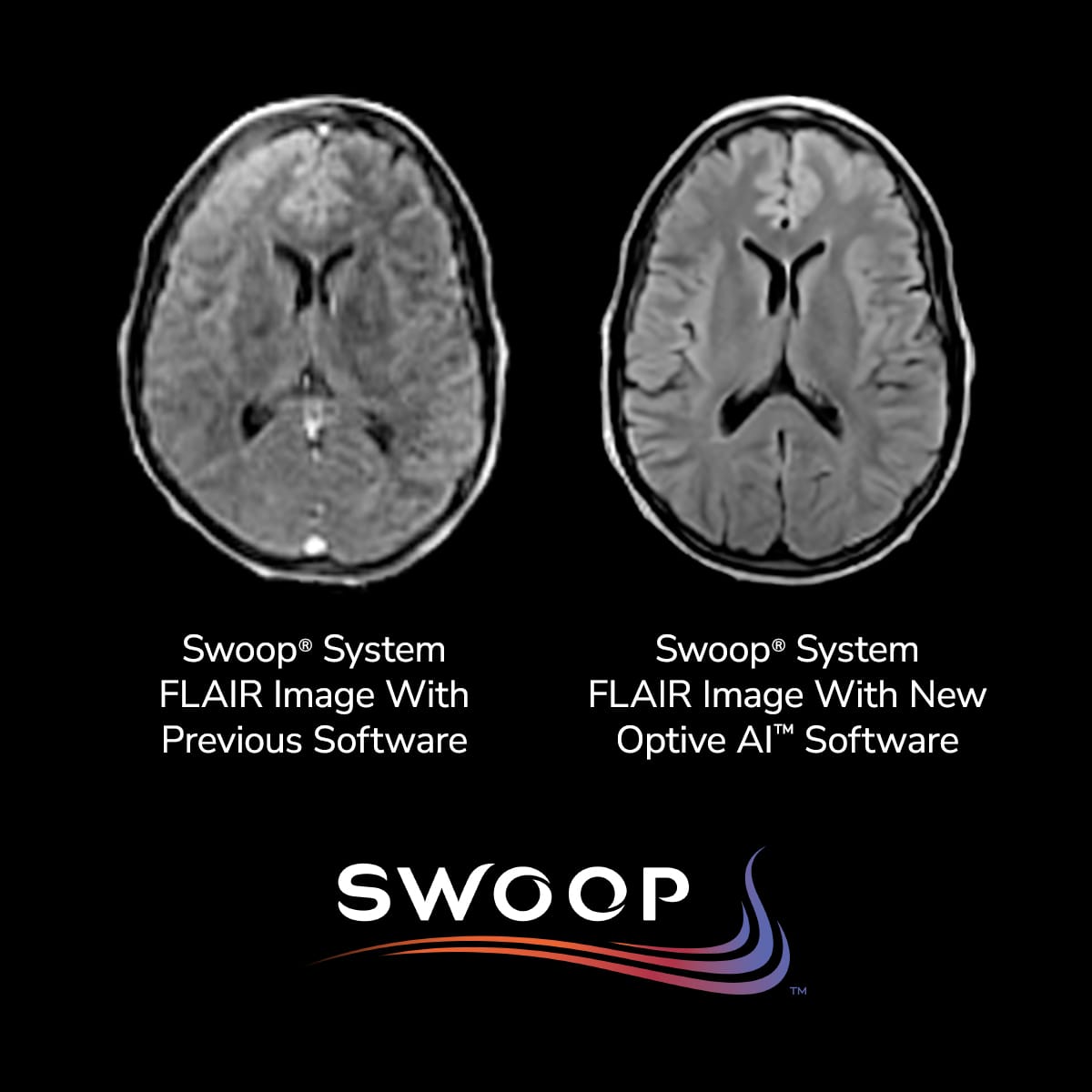 FDA Clears Next-Gen Software for AI-Enabled Portable Brain MRI