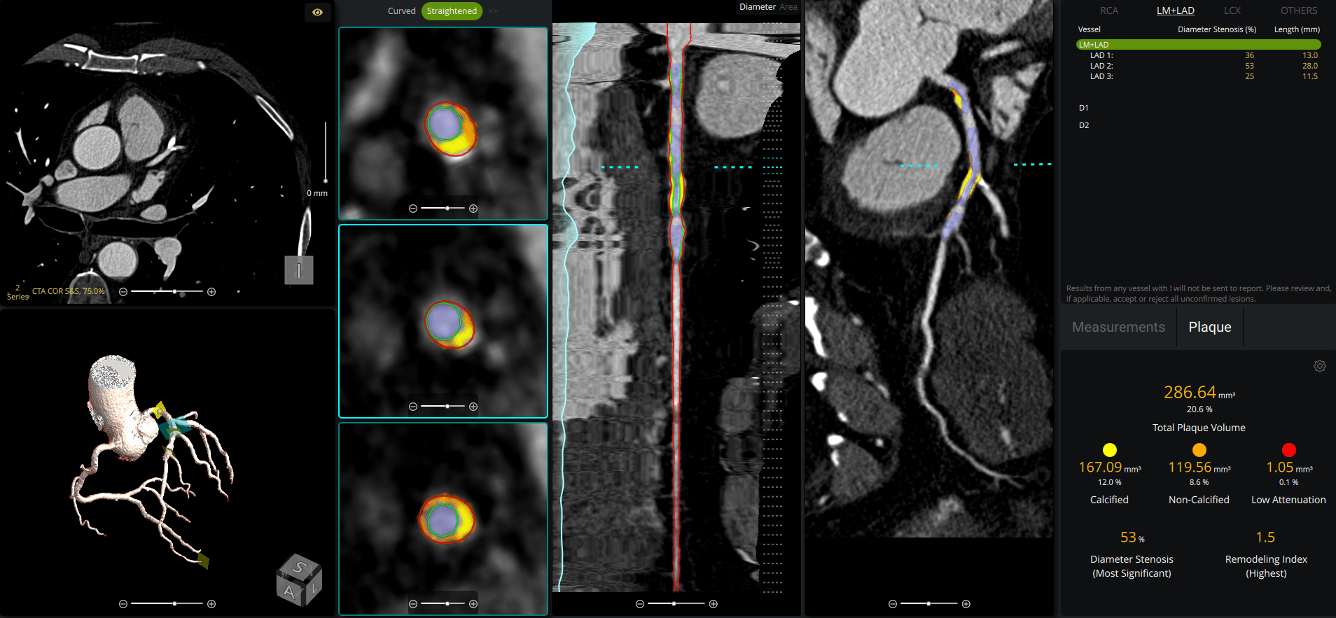 FDA Clears AI Tool for Coronary Plaque Analysis